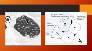 Fisiología (Lobulillo pulmonar secundario, espacio alveolar.pptx