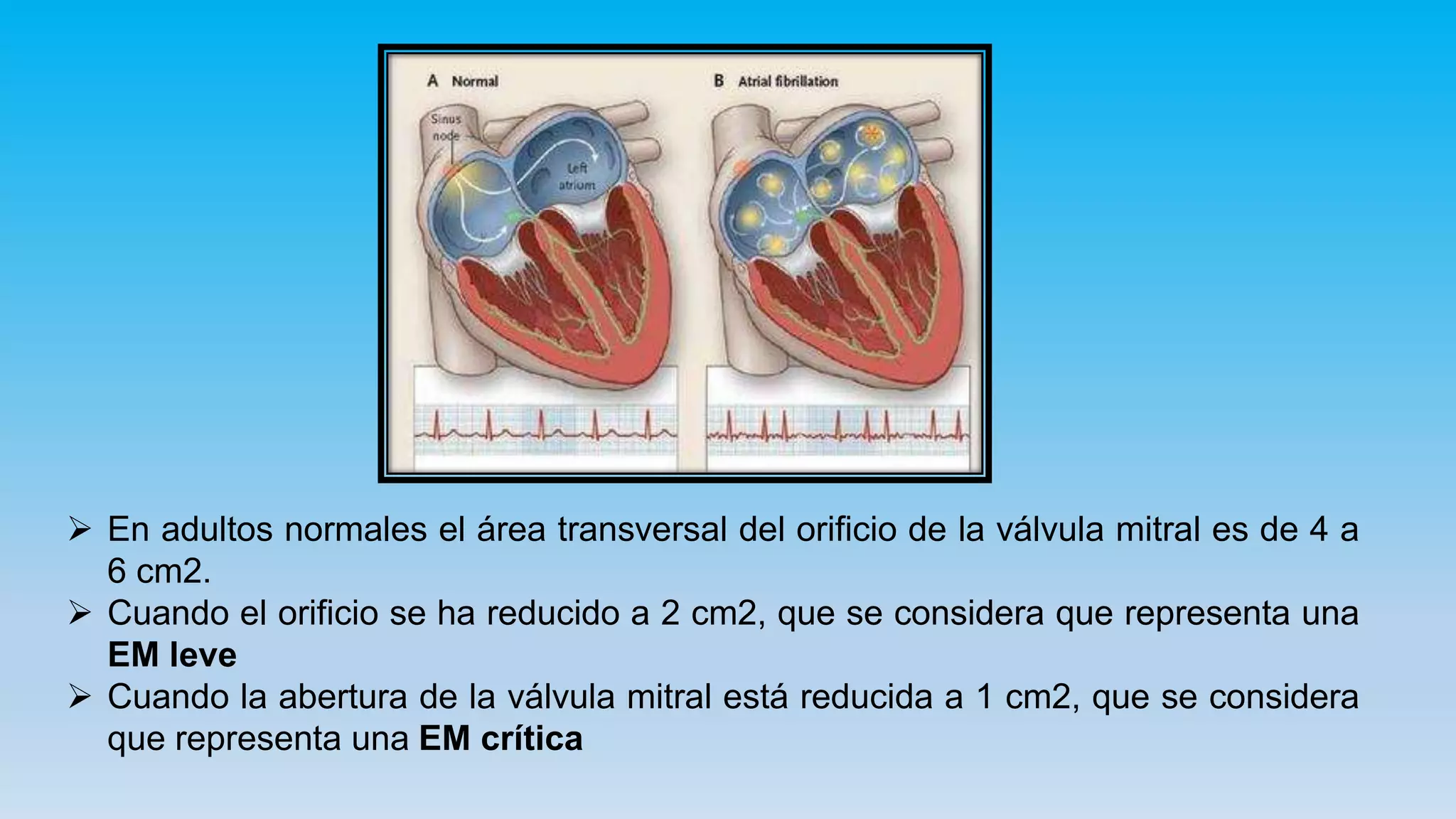 FISIOPATOLOGIA INSUFICIENCIA CARDÍACA, EDEMA PULMONAR Y ESTENOSIS ...