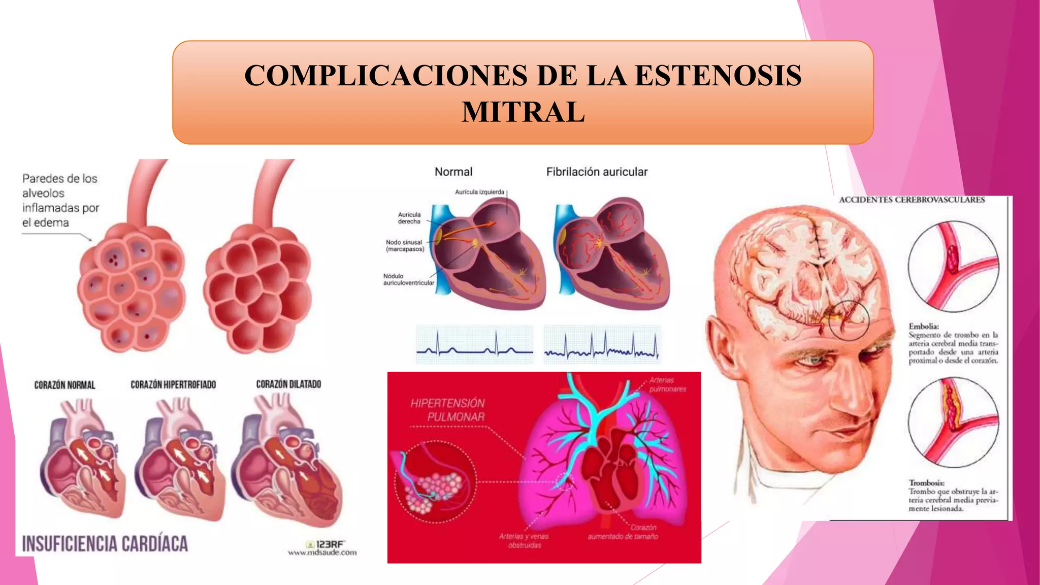 FISIOPATOLOGIA INSUFICIENCIA CARDÍACA, EDEMA PULMONAR Y ESTENOSIS ...