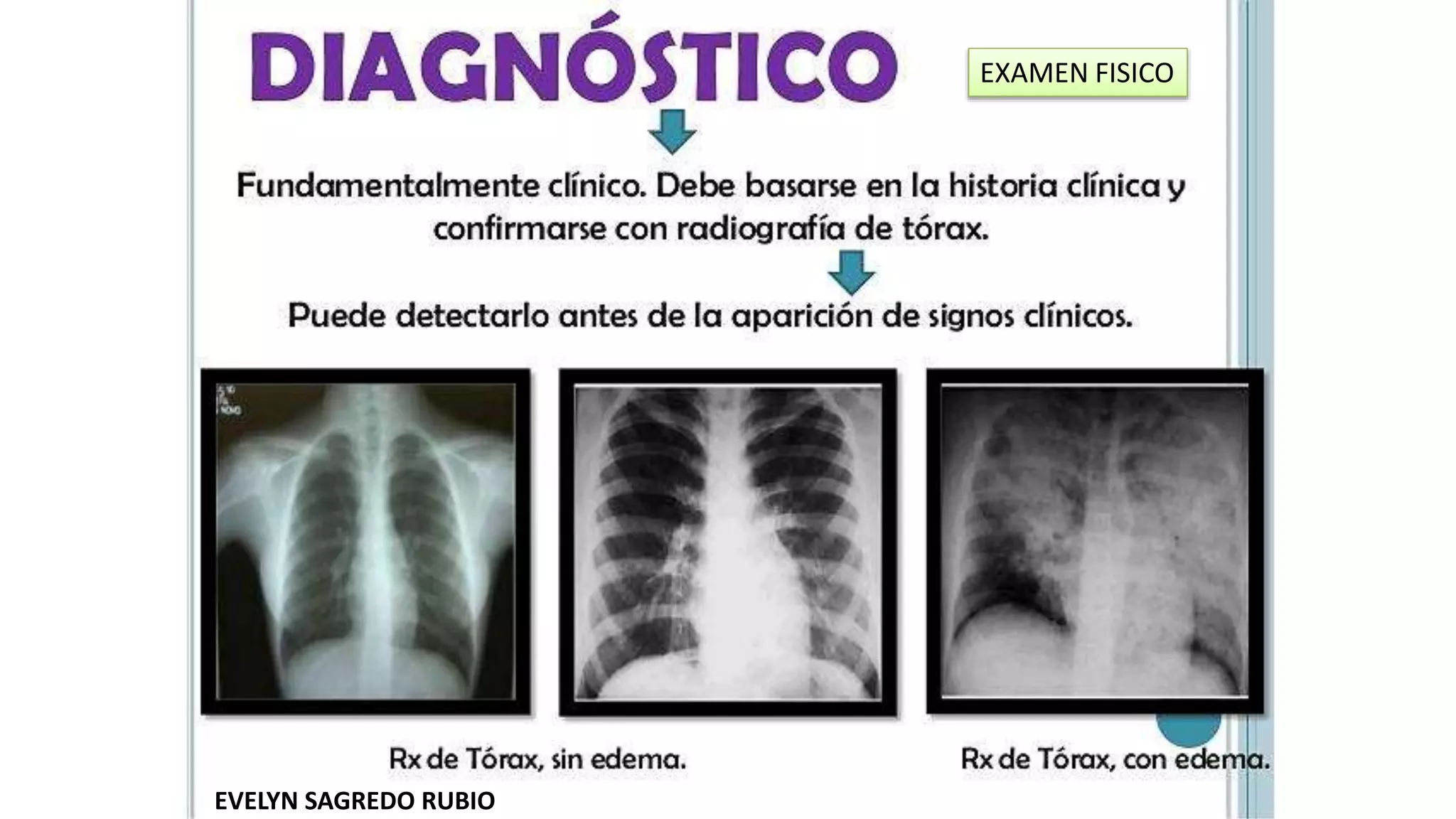 FISIOPATOLOGIA INSUFICIENCIA CARDÍACA, EDEMA PULMONAR Y ESTENOSIS ...