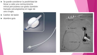Fisiopatologia Insuficiencia CardÍaca Edema Pulmonar Y Estenosis