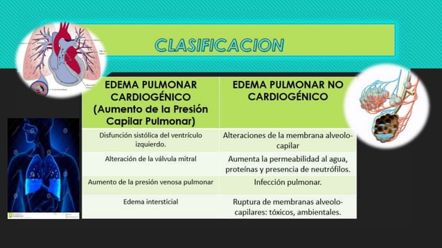 Fisiopatologia Insuficiencia Cardíaca Edema Pulmonar Y Estenosis