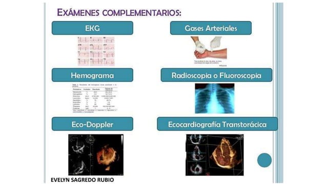 FISIOPATOLOGIA INSUFICIENCIA CARDÍACA, EDEMA PULMONAR Y ESTENOSIS ...