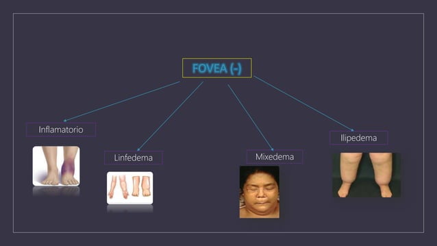 Fisiopatología del edema | PPTX | Lung and Respiratory Health ...