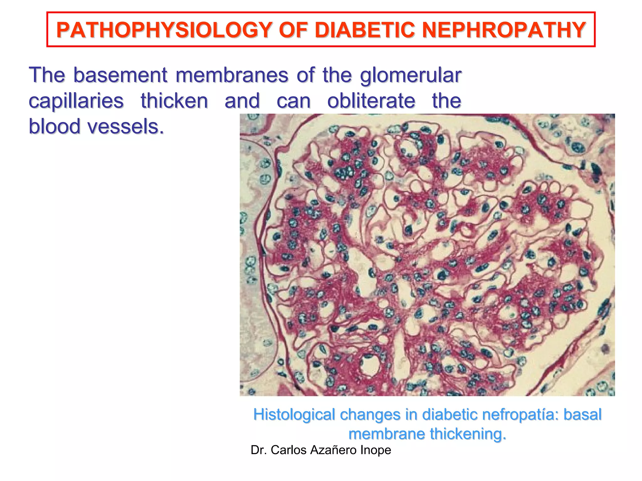 PATHOPHYSIOLOGY OF DIABETIC NEPHROPATHY | PDF