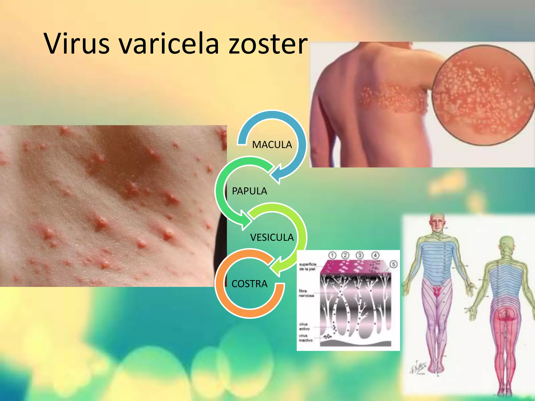 Varicela zoster | PPTX