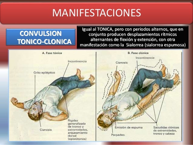Fisiopatologia convulsiones y epilepsias