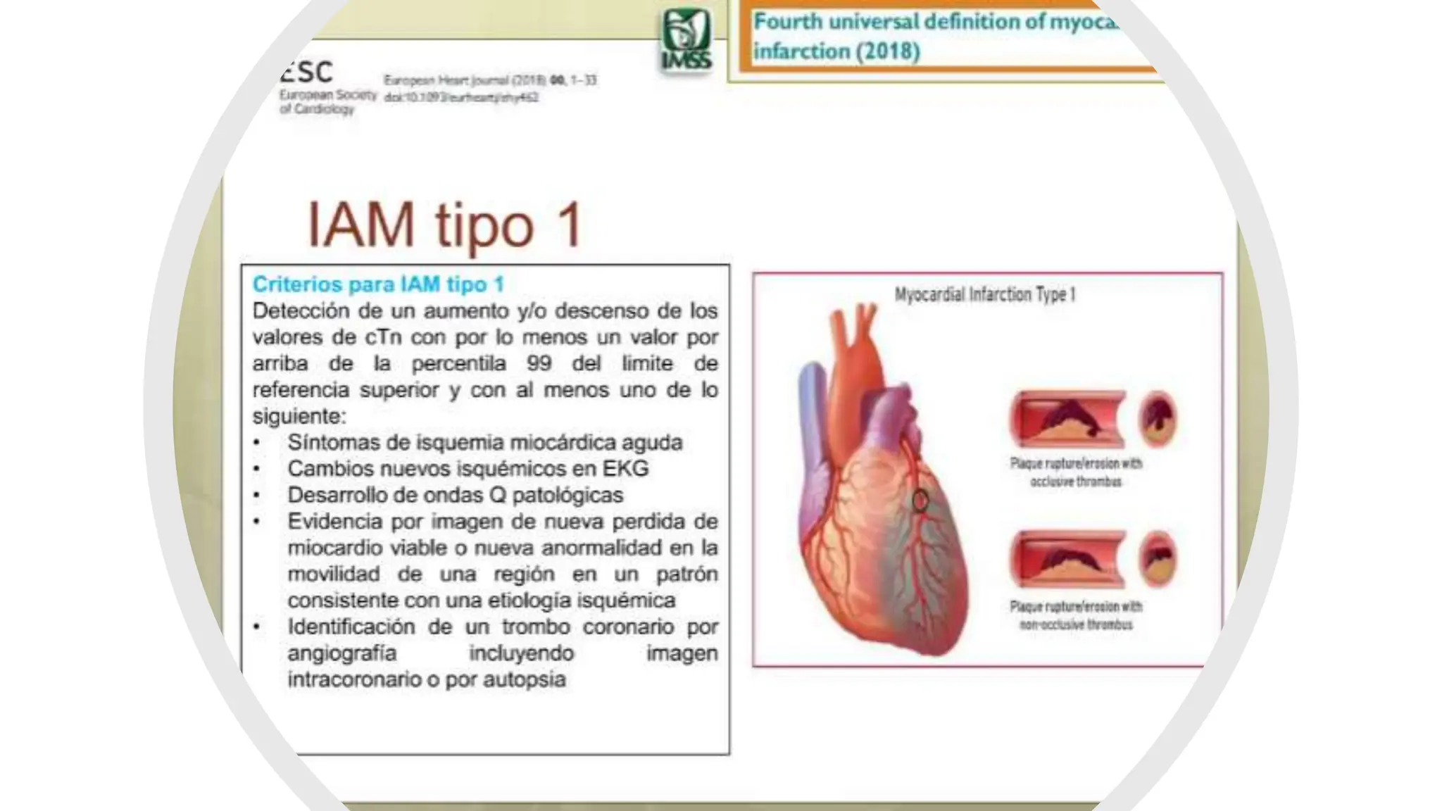 patologia y fisiopatología del Infarto Agudo de Miocardio | PPTX