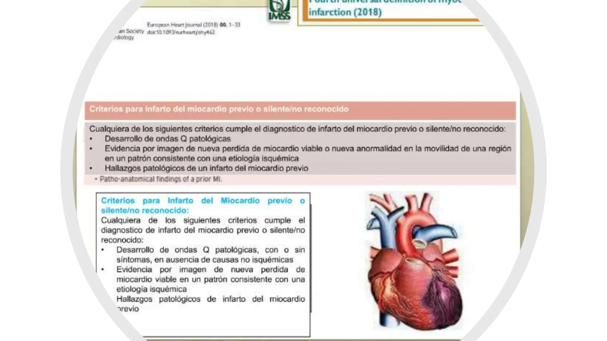 patologia y fisiopatología del Infarto Agudo de Miocardio | PPTX
