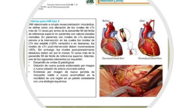 patologia y fisiopatología del Infarto Agudo de Miocardio | PPTX