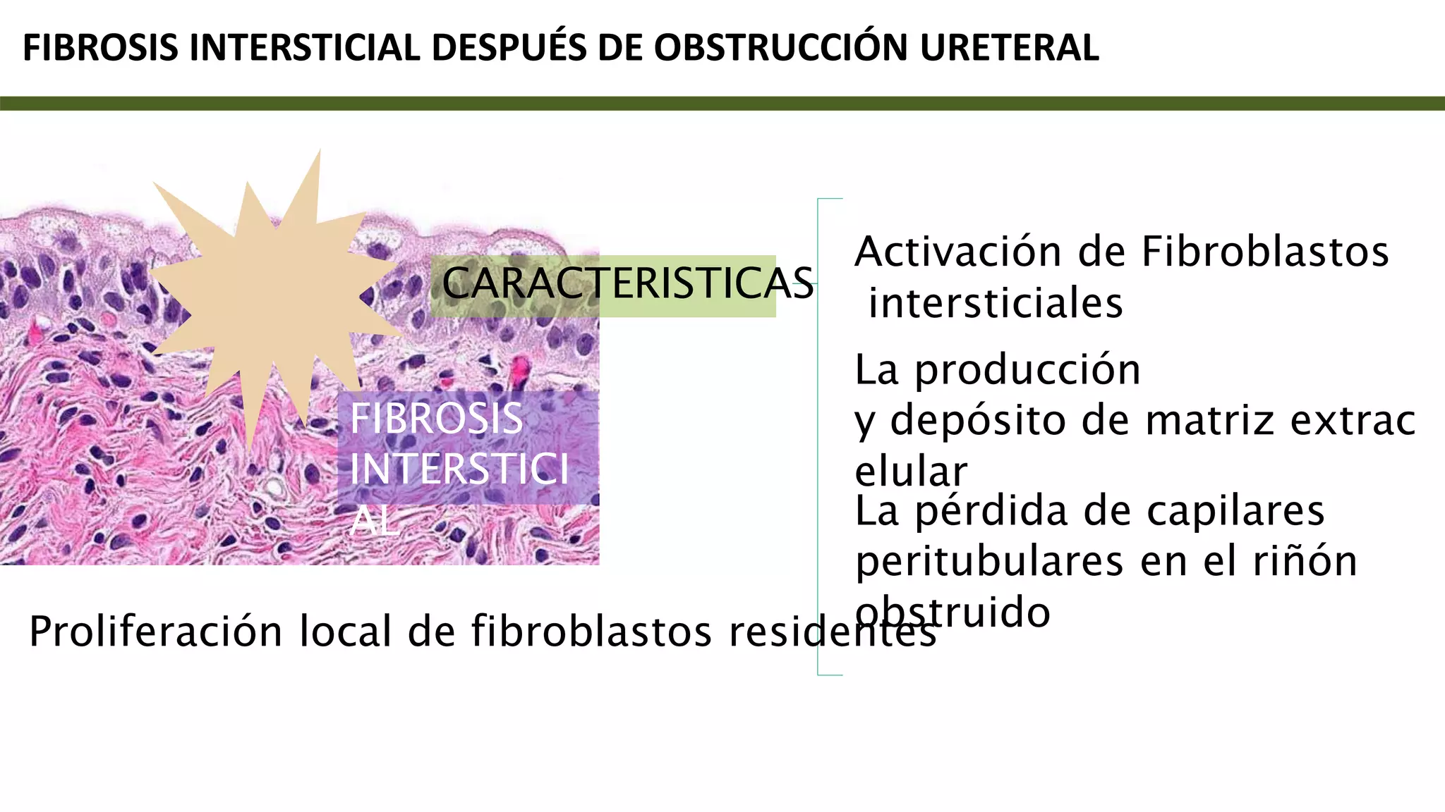 Fisiopatologia de la uropatia obstructiva | PPTX