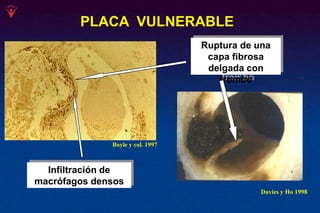 Fisiopatologia Síndrome Coronario Agudo | PPT