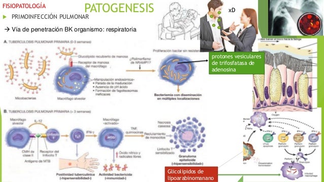 FISIOPATOLOGIA DE LA TUBERCULOSIS