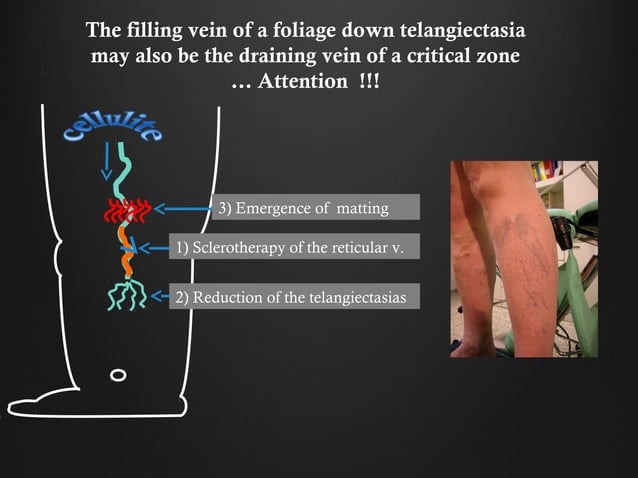 Useful physiopathology of telangectasia | PPT | Blood Disorders ...