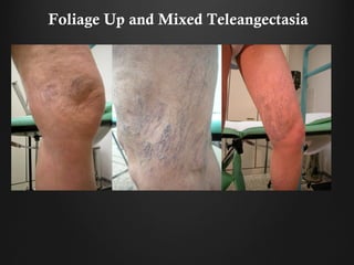 Useful physiopathology of telangectasia | PPT