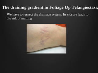 Useful physiopathology of telangectasia | PPT