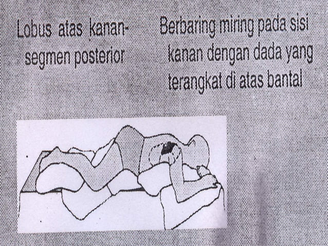 Fisioterapi dada.ppt