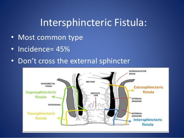 Fissure and fistula