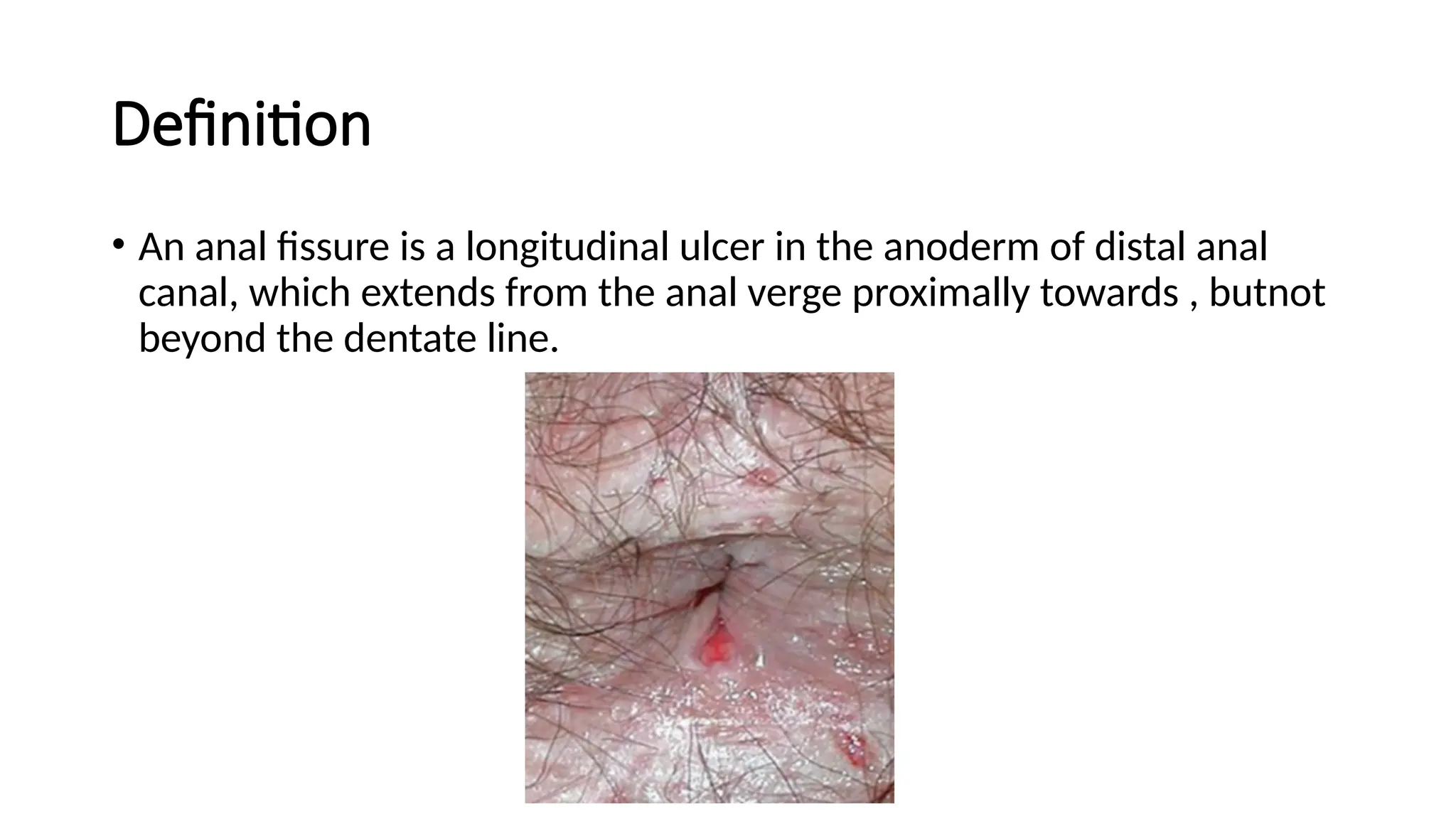 FISSURE AND HEMORRHOID.pptx ...