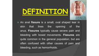 fissures.pptx/////////////////////////// | PPT