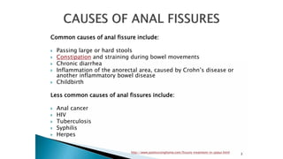 fissures.pptx/////////////////////////// | PPT