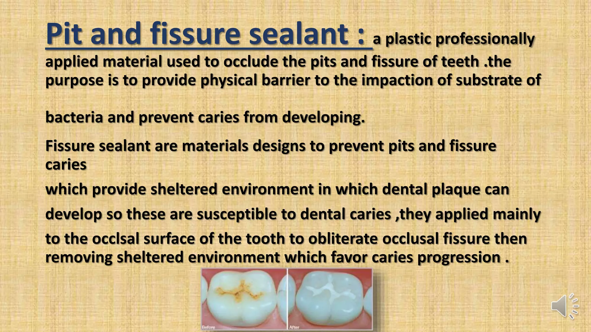 Fissure sealant | PPTX
