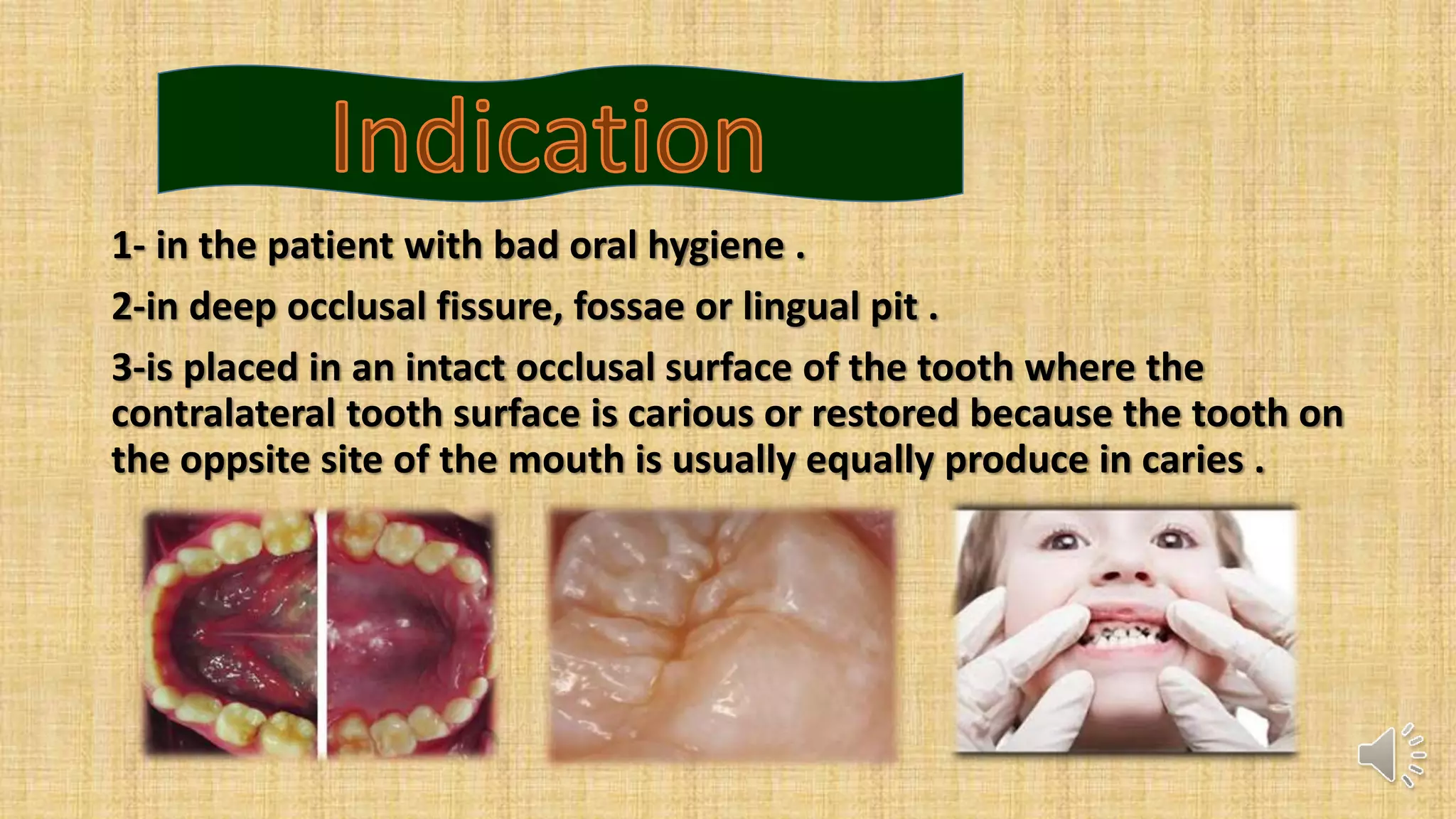 Fissure sealant | PPTX
