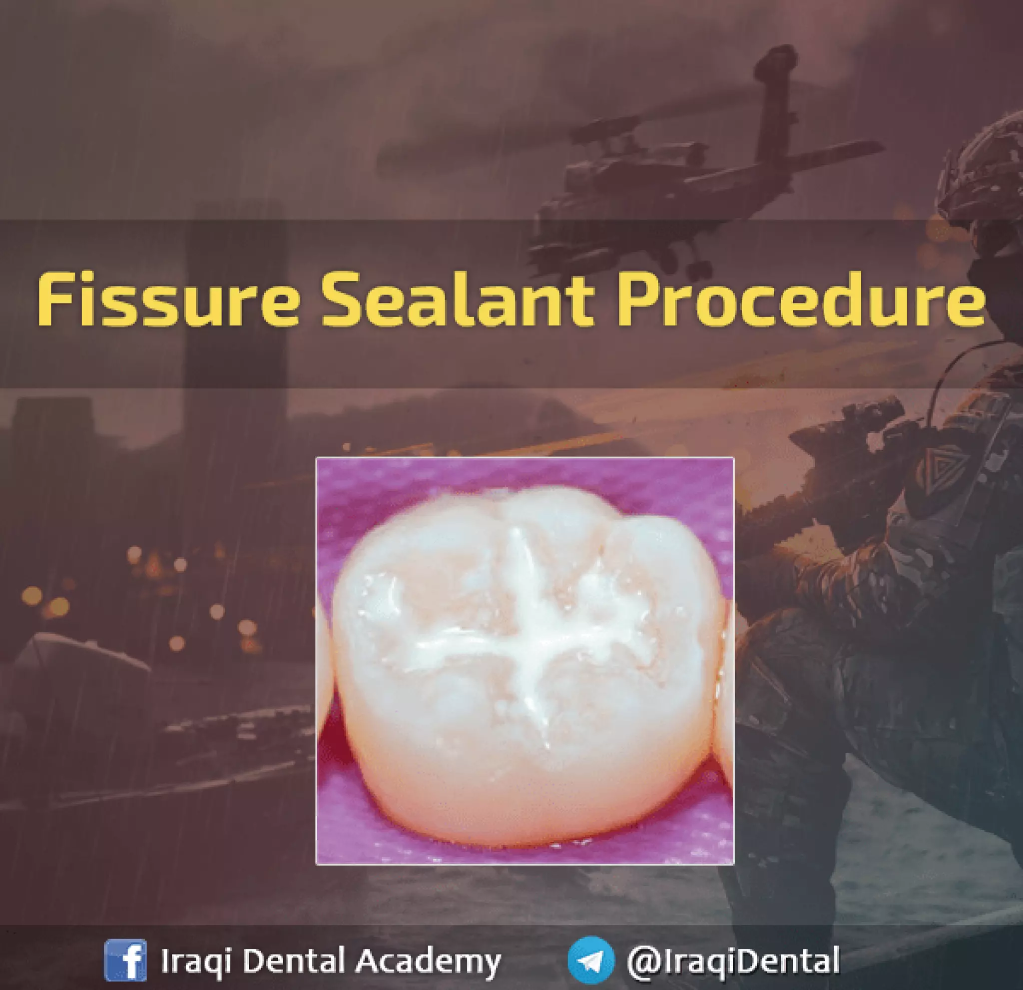 Fissure Sealant Procedure Explained | PDF