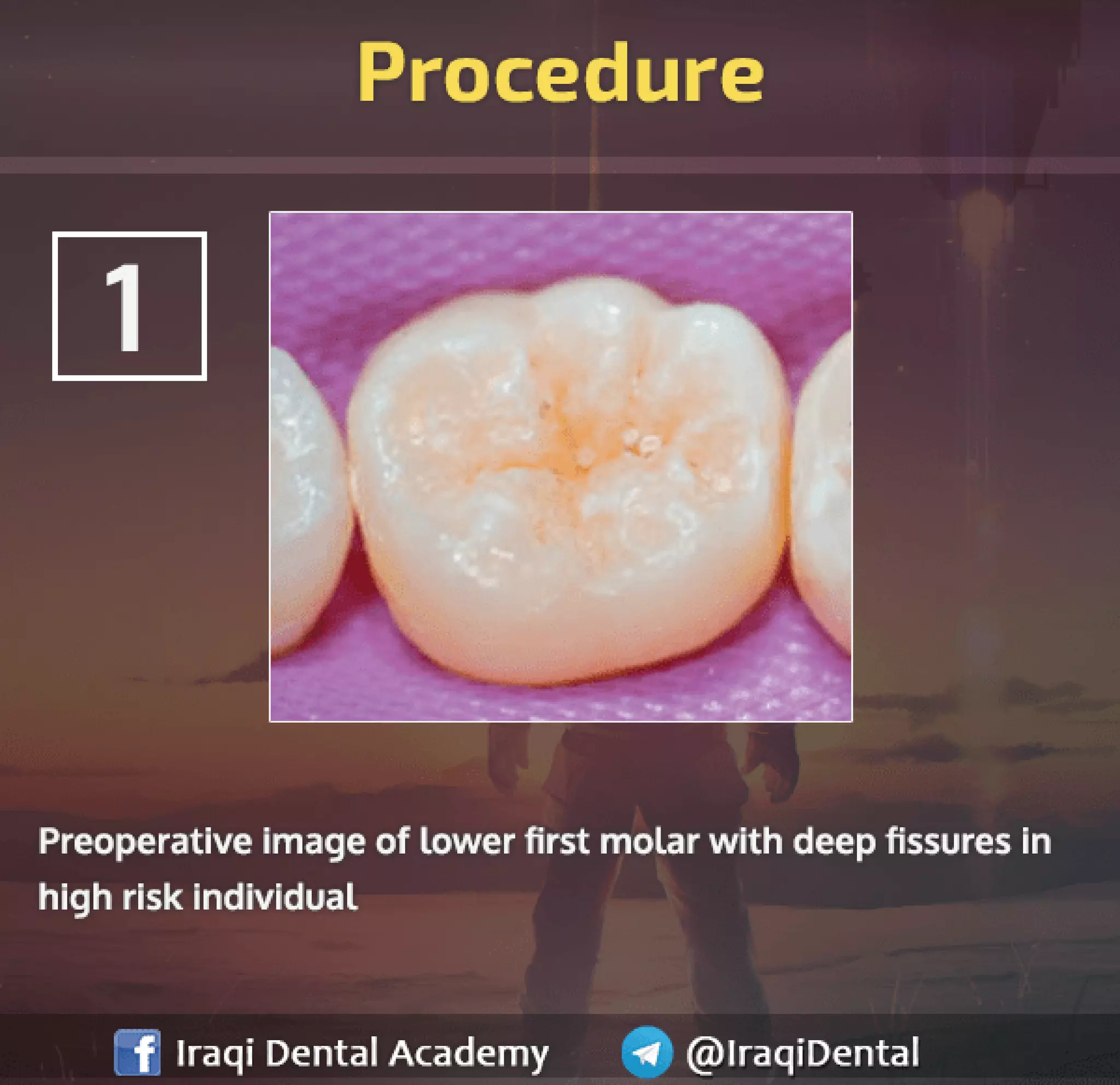 Fissure Sealant Procedure Explained | PDF