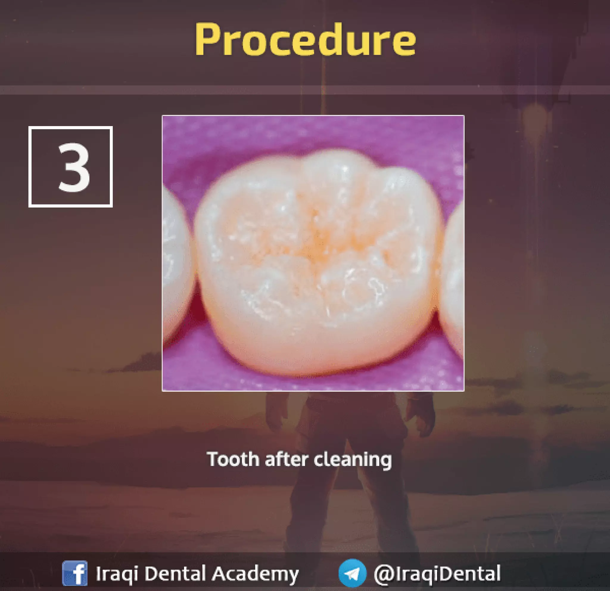 Fissure Sealant Procedure Explained | PDF