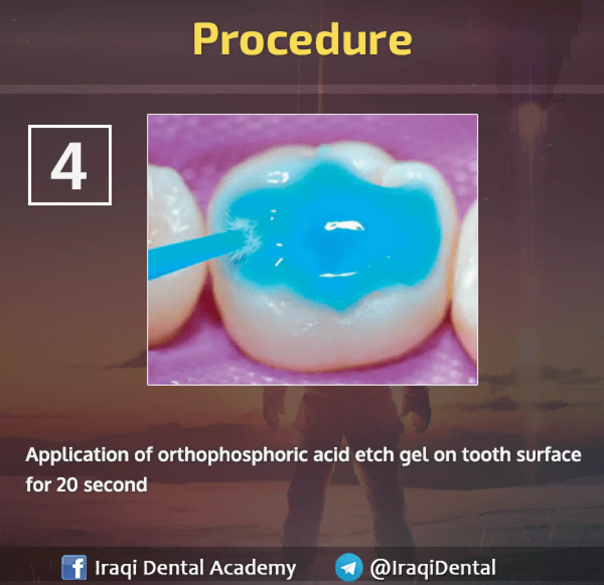 Fissure Sealant Procedure Explained | PDF
