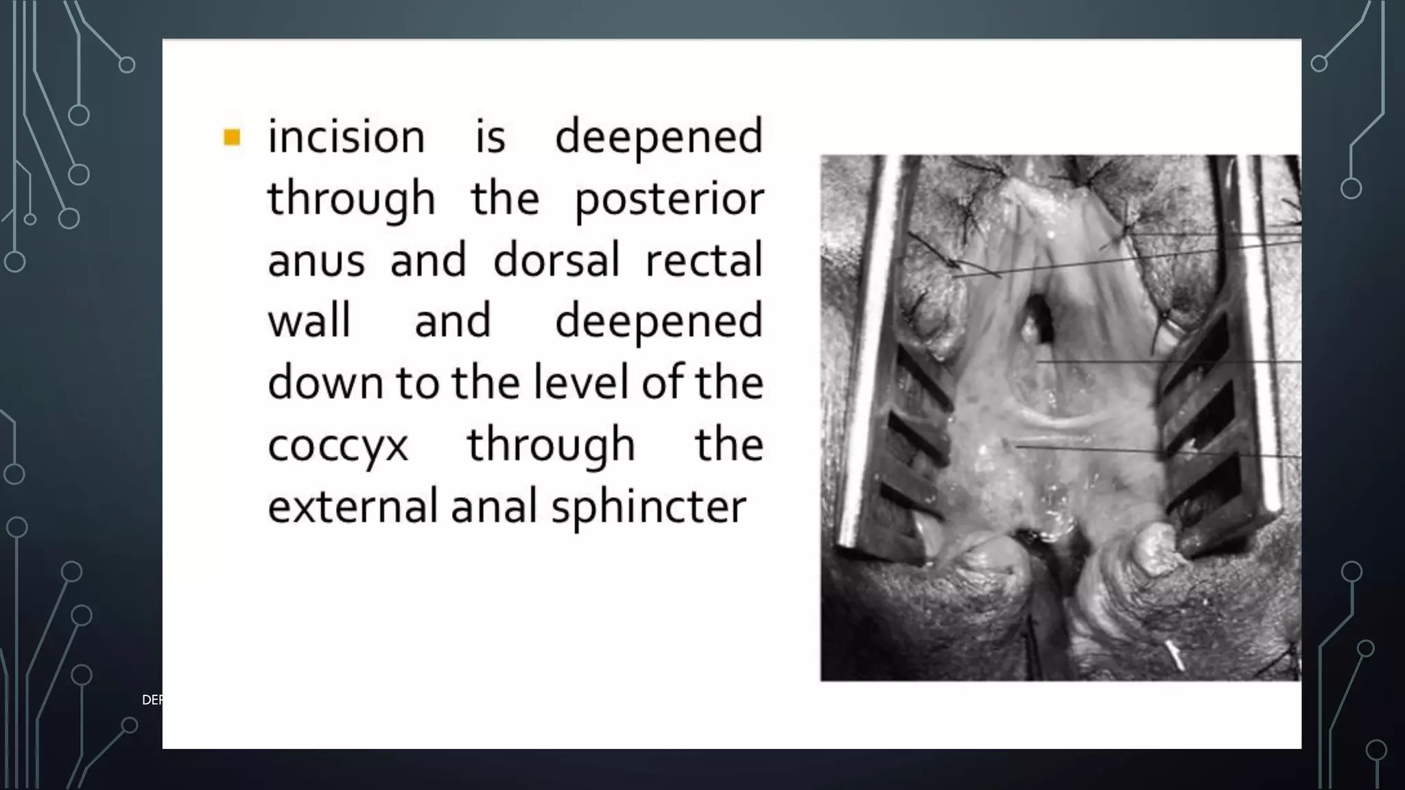 Fistulae excluding gu fistula | PPT
