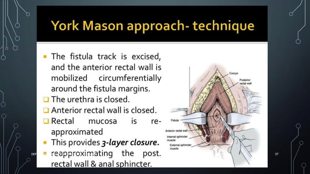 Fistulae excluding gu fistula | PPT