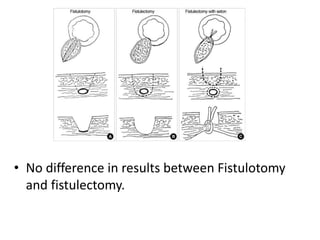 Fistula | PPTX