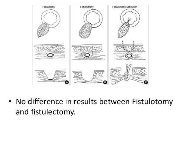 Fistula