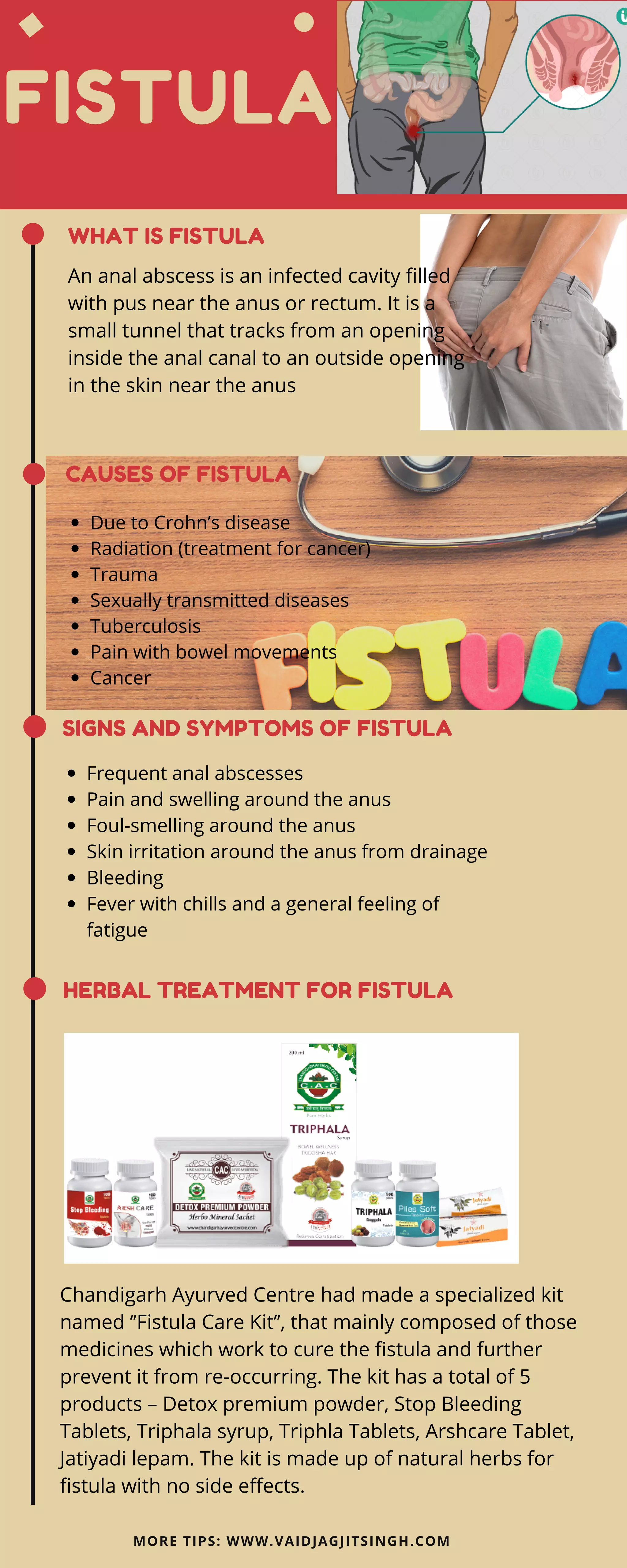Fistula - Causes, Symptoms and Herbal Treatment | PDF