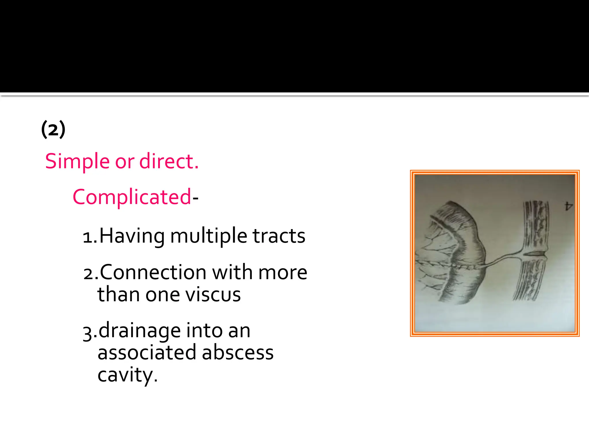 fistula, causes, risks complications.pptx