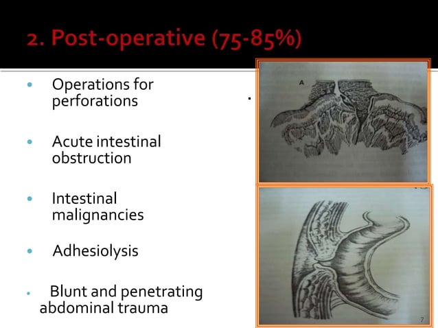Fistula Causes Risks Complicationspptx 4711