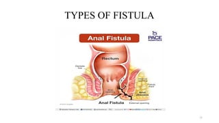 A slide on Fistula and its management.pptx