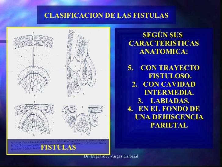 Fistula Enterocutanea