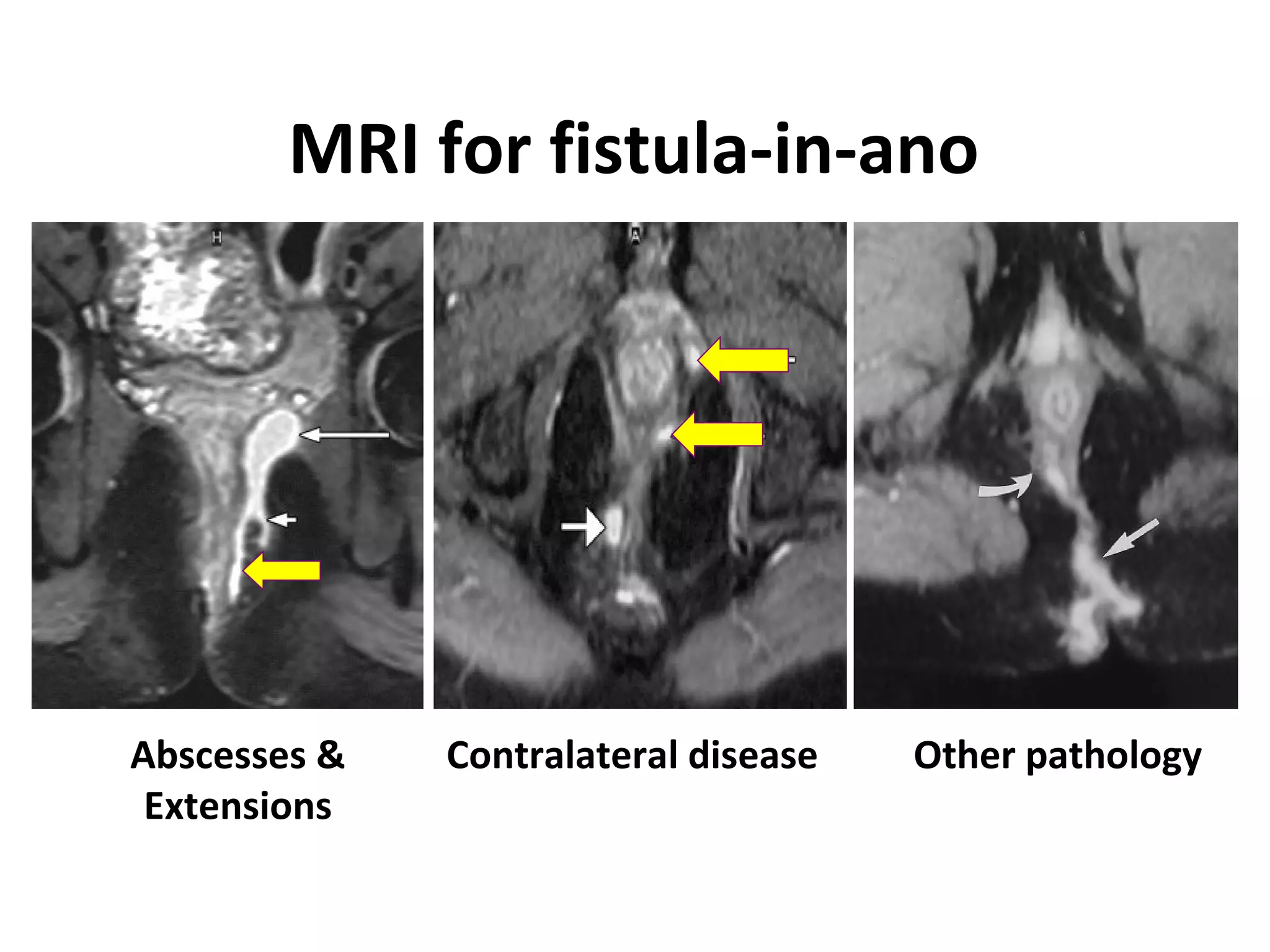 Fistula in-ano | PPT