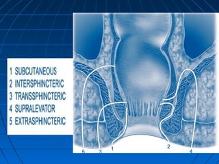 Fistula in-ano | PPT