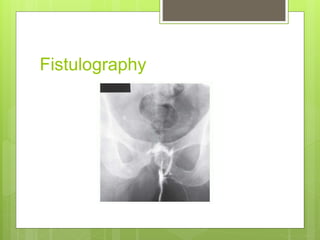 Fistula in-ano | PPTX
