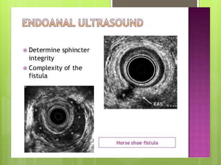 Fistula in-ano | PPTX