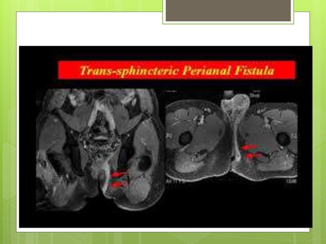 Fistula in-ano | PPT