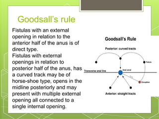Fistula in ano - classification and management | PPTX