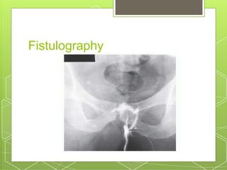 Fistula in ano - classification and management | PPTX