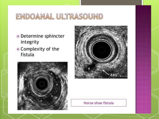 Fistula in ano - classification and management | PPTX