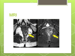 Fistula in ano - classification and management | PPTX