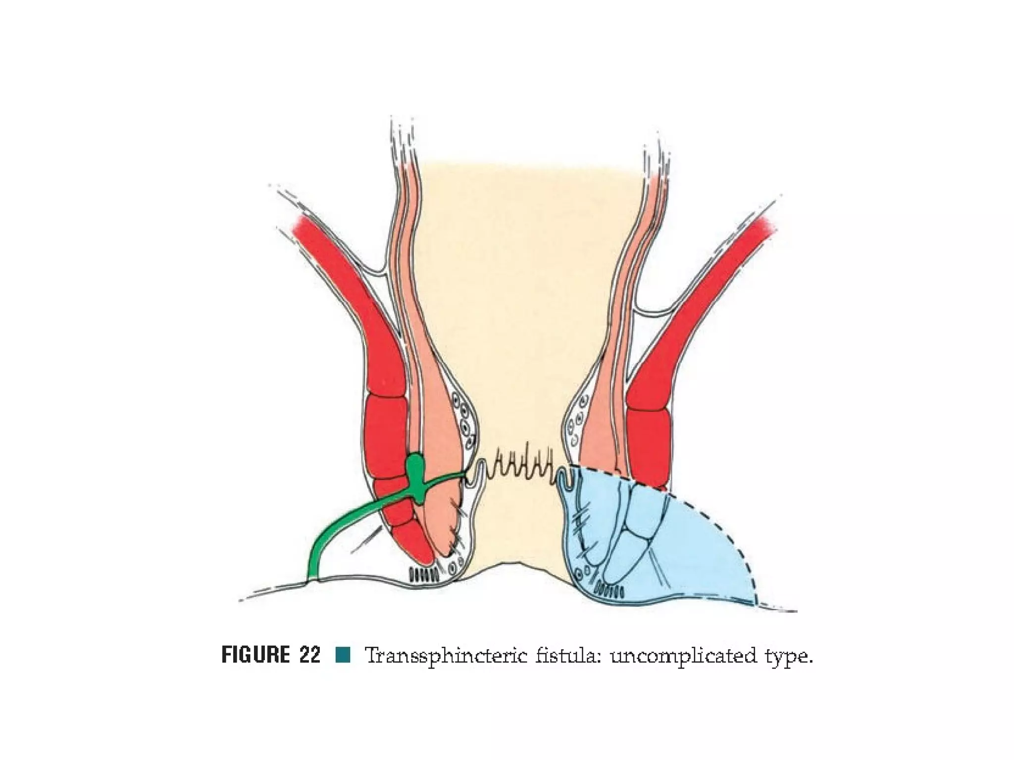Fistula in-ano | PPT